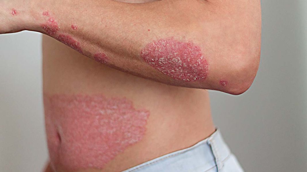 Psoriasis or eczema: What's causing that itchy rash?