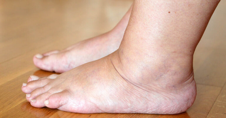 How physical therapy can help with lymphedema
